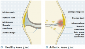 Osteoarthritis: breaking the cycle - Neuro Rehab Times