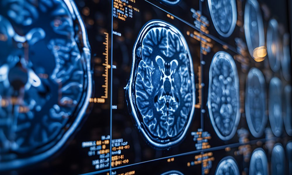 Car accidents can lead to brain injuries: A guide to identifying the ...